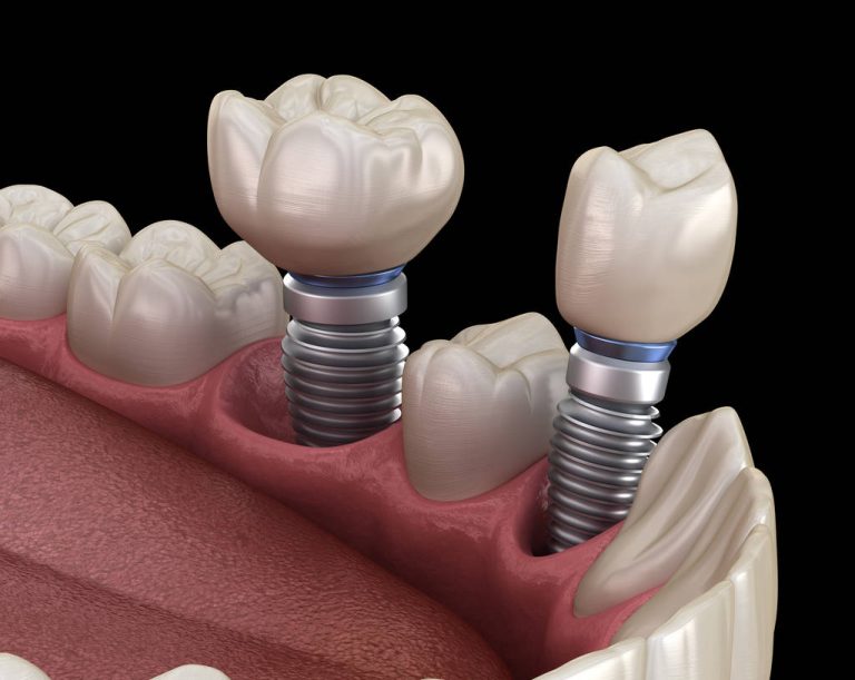 Can You Have Multiple Teeth on One Implant? - Peppard Dental Service
