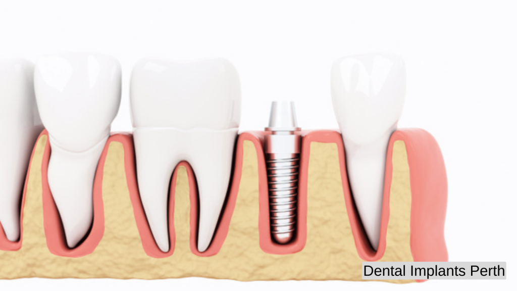 High-Quality Dental Implants in Perth: Restoring Your Smile with ...
